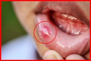 Afta: como tratar, evitar e remédios caseiros | Dr. Saúde